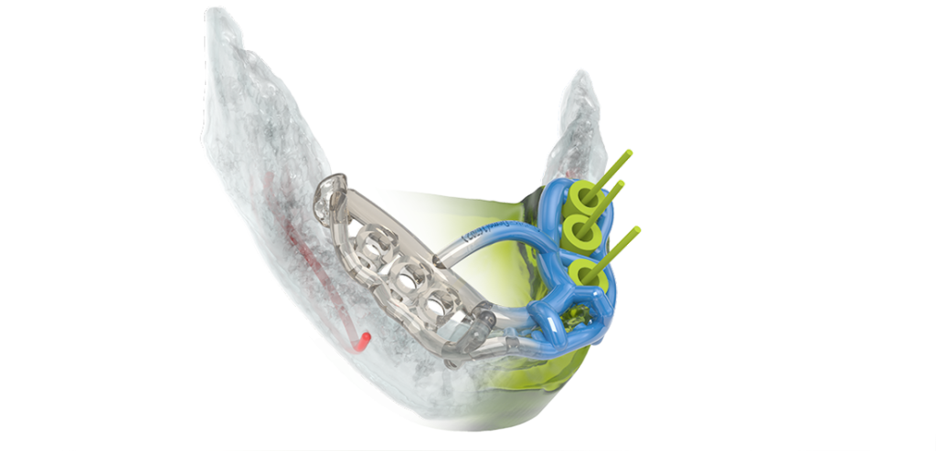 3D Implantat Planung – Guided Surgery mit 'smop' Hands on Workshop ...